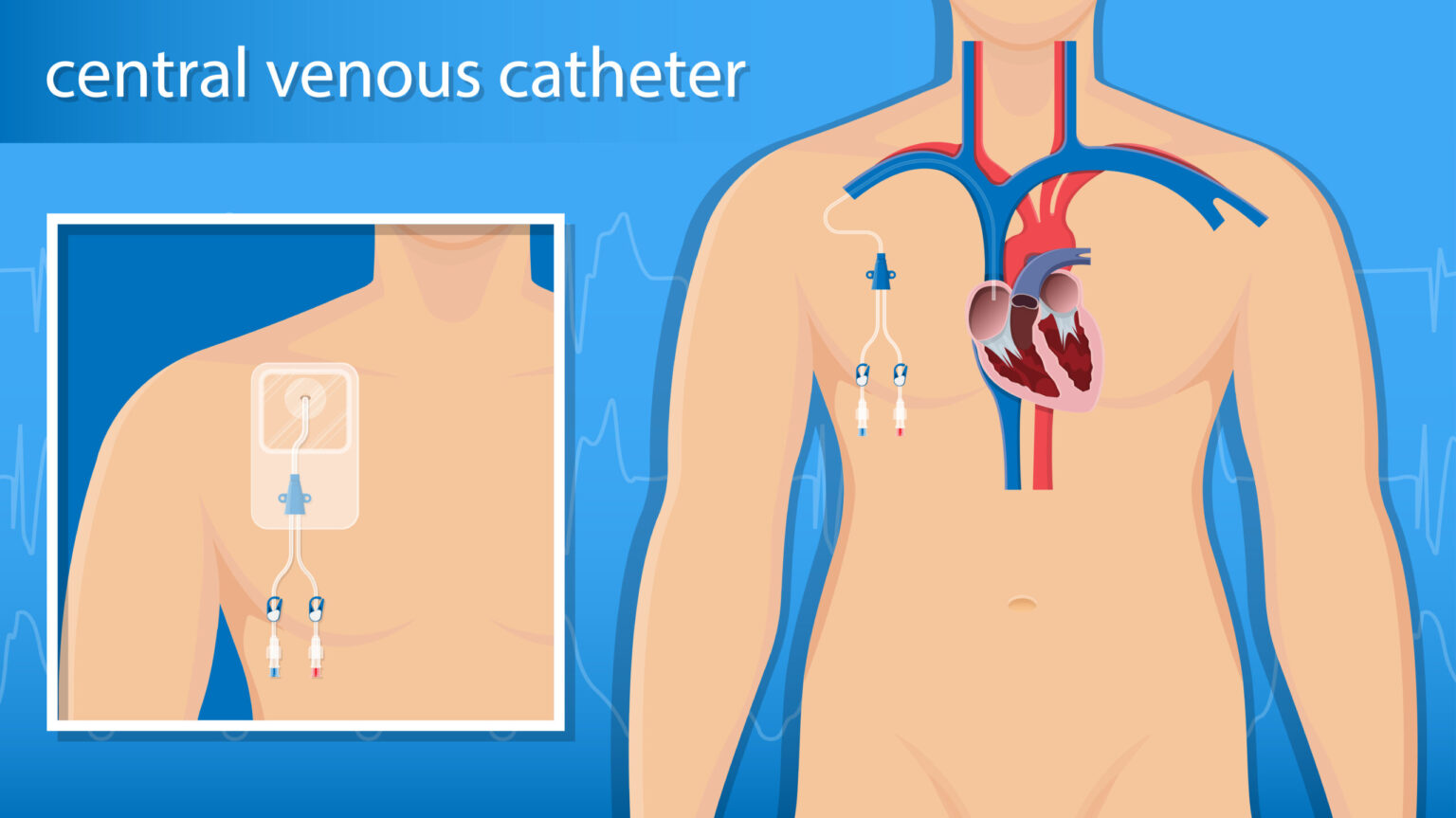 Non-Tunnelled Central Venous Catheter Segment Is The Largest